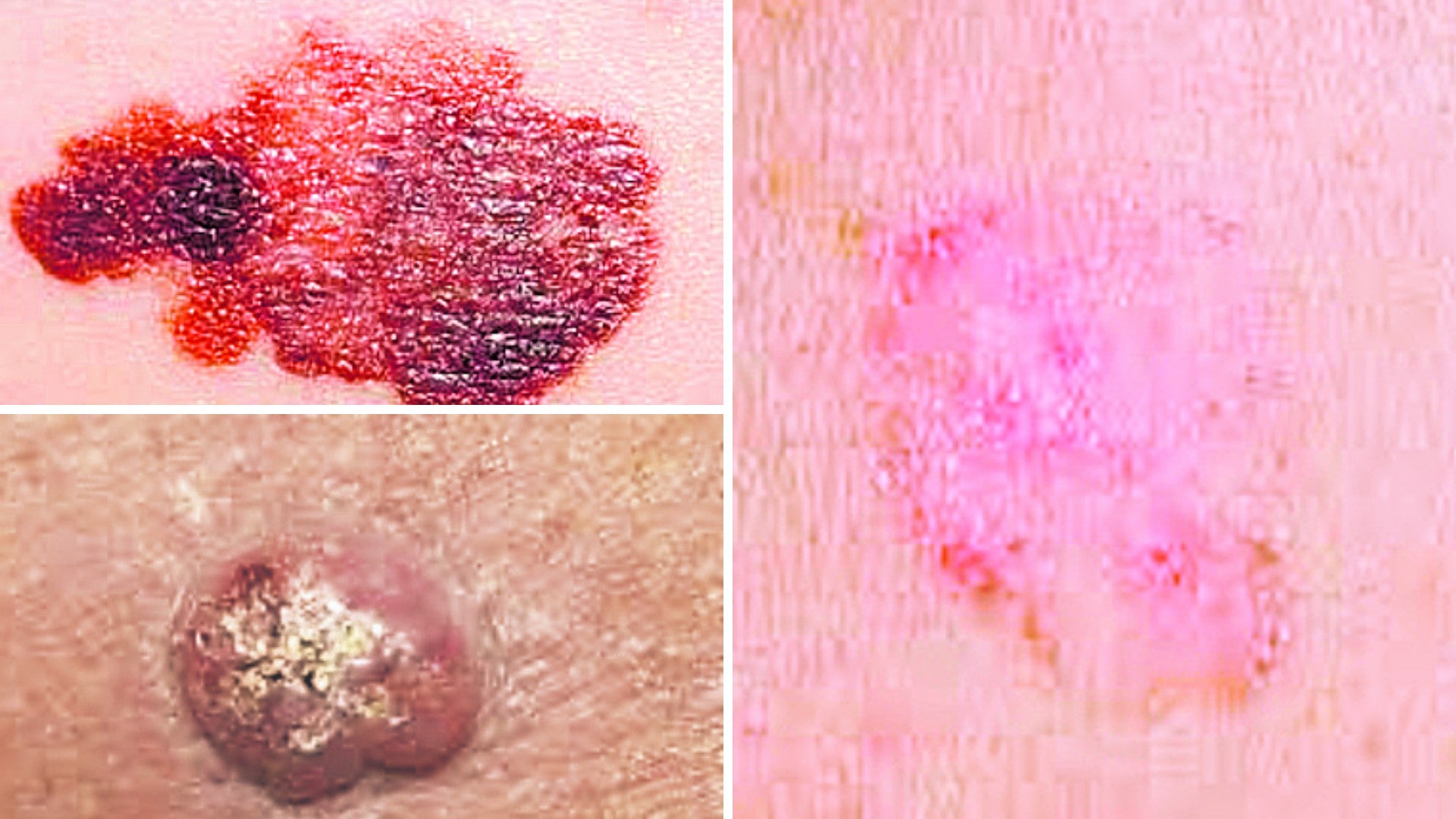 Cómo detectar estos tipos de cáncer de piel: el bueno, el feo y el malo ...