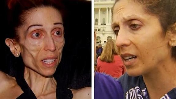 Milagrosa recuperación de una joven anoréxica 5 meses después de haber ...