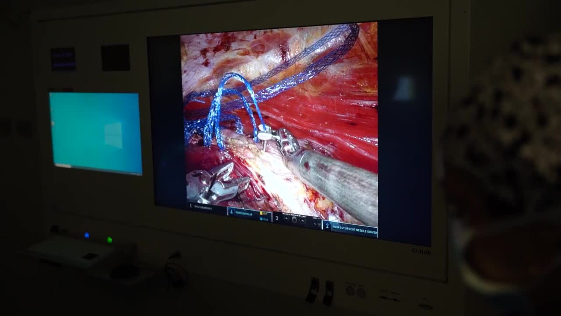 Cirugía de cáncer de colon en directo en el Hospital Virgen del Rocío ...