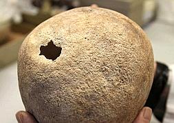 Hallado en Logroño un cráneo visigodo con un cáncer y una trepanación ...