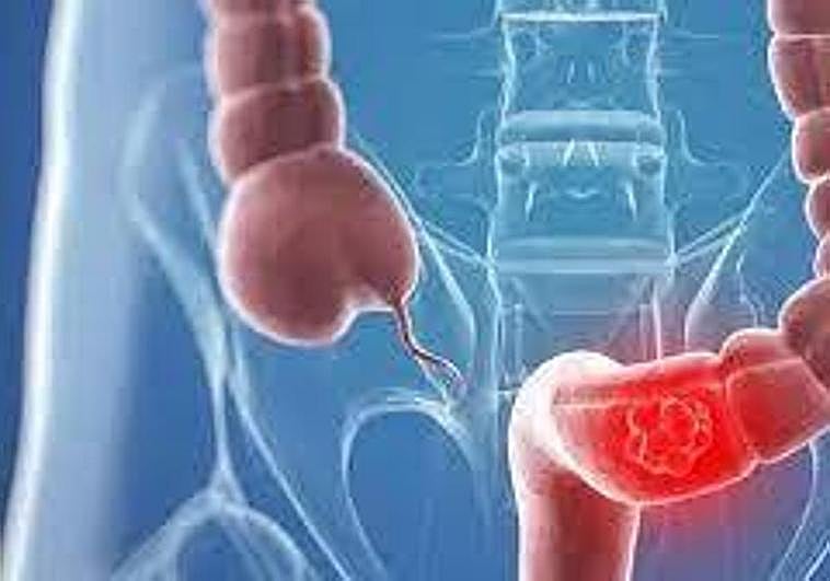 Sanidad Ampliará El Programa De Cribado Colorrectal Hasta Los 74 Años