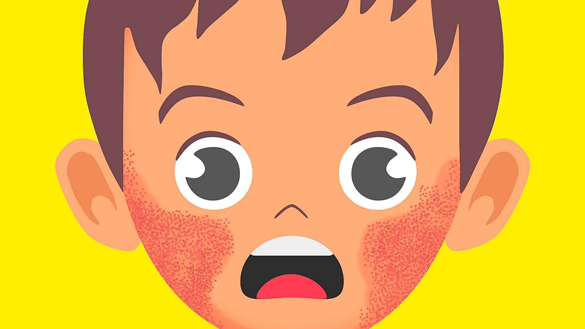 Así es la enfermedad de la bofetada que ha amargado el fin de curso a ...