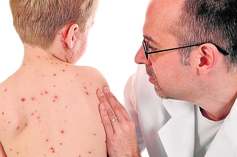 Second measles outbreak detected | Sur in English